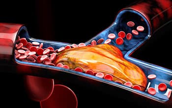Versiti - Understanding Blood Clot Lysis, or How Clots Break Down | Ze ...